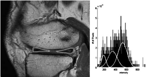 output of meniscus segmentation outlined with corresponding