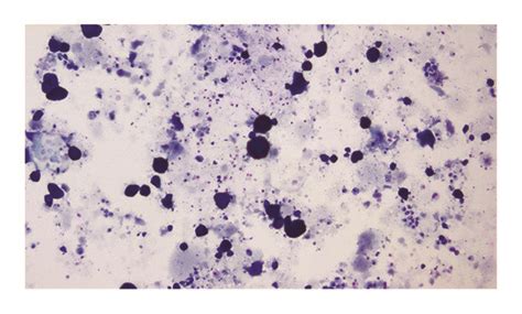 Diff Quick Stain Of Bal Fluid Showing Densely Blue Basophilic Globules