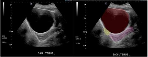 Normal Bladder Ultrasound