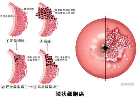 鳞状细胞癌 医学插画