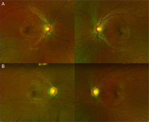 Optos Fundus Photographs Optos Marlborough Ma Demonstrating Optic Download Scientific