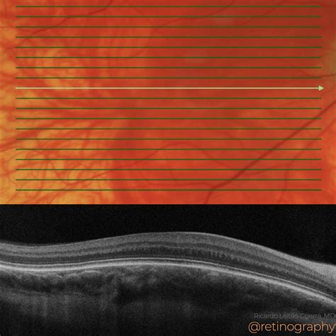 Ocular Albinism Retinography