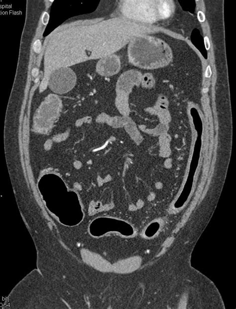 Ulcerative Colitis With Prominent Vascular Vasa Recta Colon Radiology