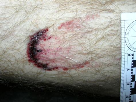 Deformutilation Postmortem Patterned Abrasions