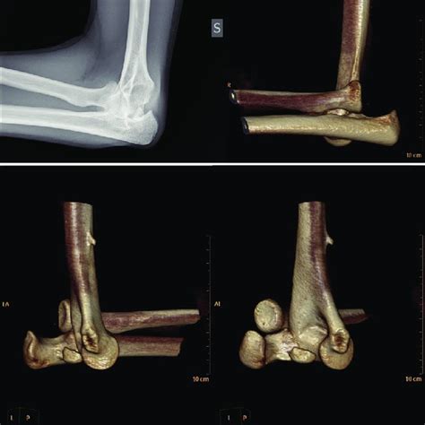 X Ray And 3d Ct With Fracture Dislocation Of The Left Elbow Download