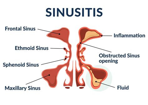 Sinusitis Symptoms At A Glance Practical Tips