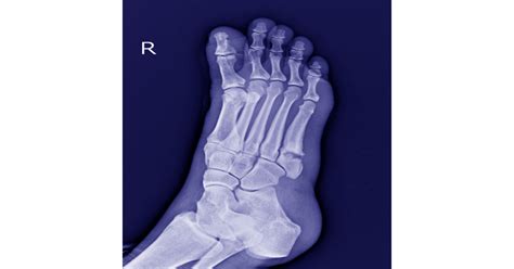 Stryker Dominates Global Small Bone And Joint Market With Depuy Synthes And Zimmer Biomet In