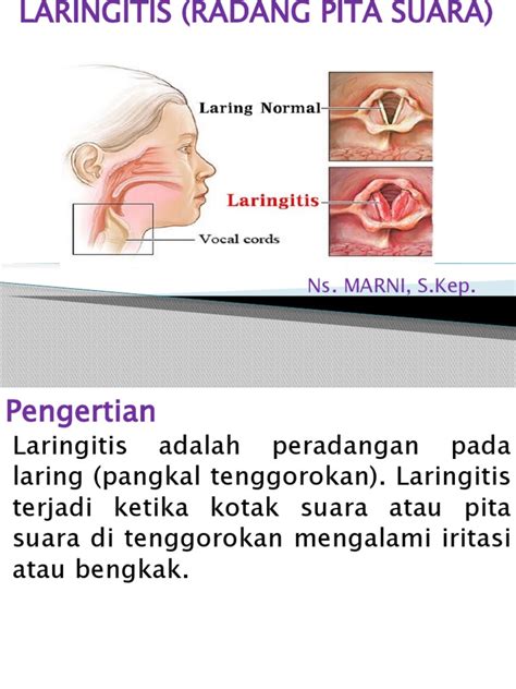 Laringitis Pdf