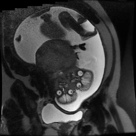 Radiopaedia Case Conjoined Twins Cephalo Thoraco Omphalopagus Id