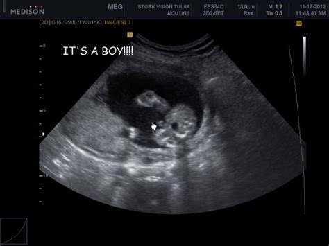 La Cate Saptamani Se Vede Sexul Copilului Nastenaturalro