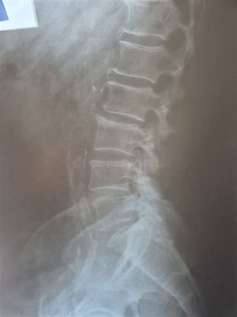 X Ray Of The Cervical Bones Of The Neck Stock Image Image Of