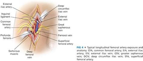 Occlusive Disease Management Iliac Angioplasty And Femoral