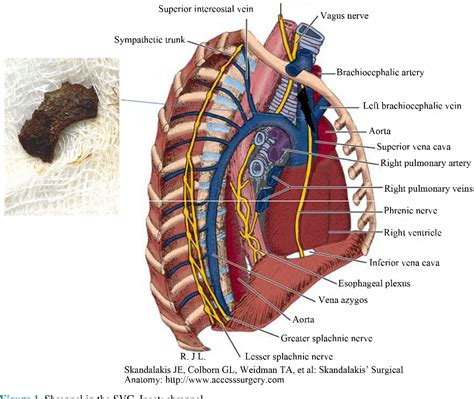Superior Vena Cava