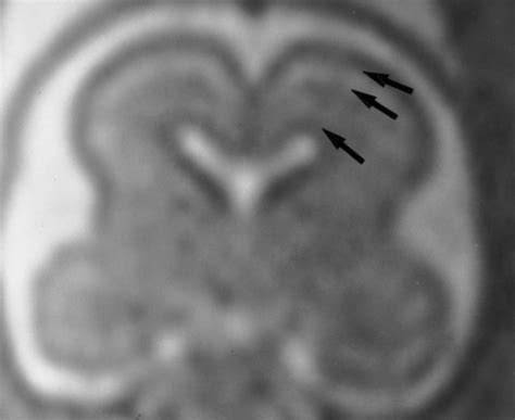 T2 Weighted Fast Mr Imaging With True Fisp Versus Haste Comparative