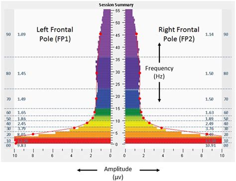 Fast Fourier Transform Spectral Display Of 1 Min Recording Of Brain