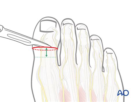 Amputation For Partial Articular Fractures Of The Proximal Hallux