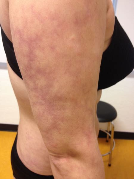 Sneddon Sendromu Nedir