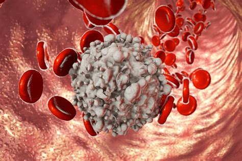 Time Is Key Is Leukemia Curable If Caught And Treated Early Liv