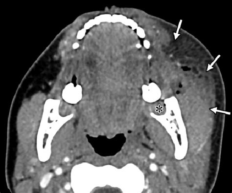 Cellulitis After Third Molar Extraction Axial Contrast Enhanced Ct Download Scientific Diagram