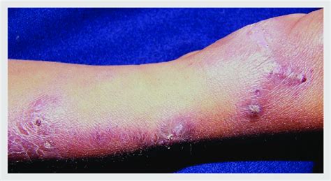 Clinical Image Lymphocutaneous Sporotrichosis Download Scientific