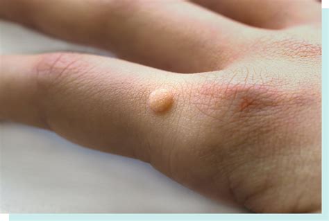 Warts Removal