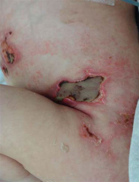 Scielo Brasil Pyoderma Gangrenosum In A Newborn Case Report
