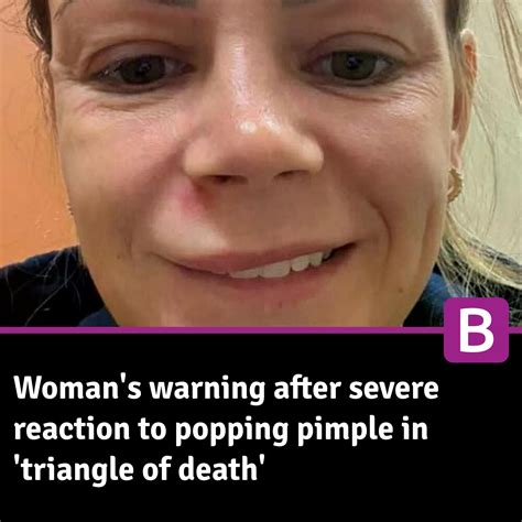 Birmingham Alisha Monaco Had No Idea The Pimple She Picked Was In The Triangle Of Death Zone