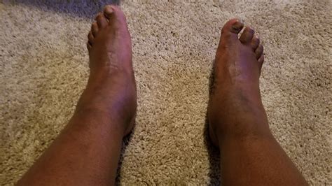 Why Do My Legs Look Like Sticks At Lucas Cade Blog