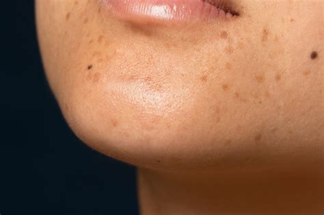 Sun Damaged Skin Photoageing A Complete Guide