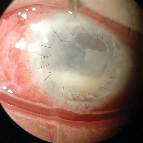 Corneal Ulcer Hypopion Download Scientific Diagram