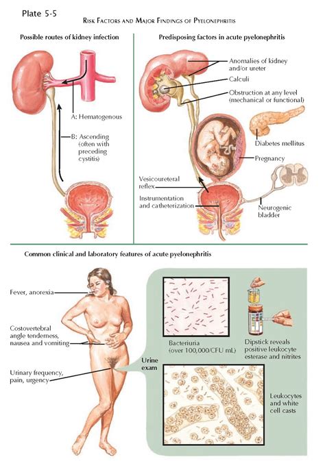 Pyelonephritis Pediagenosis