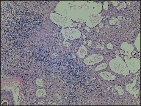 A Patient With Multiple Asymptomatic Yellow Papules On The Scalp
