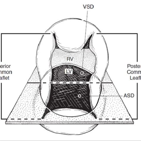 Rastelli Classification Of Complete Atrioventricular Canal Defects A