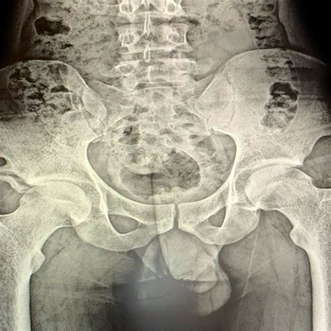 Pelvis Anteroposterior X Ray Showing A Right Anterior Inferior Iliac