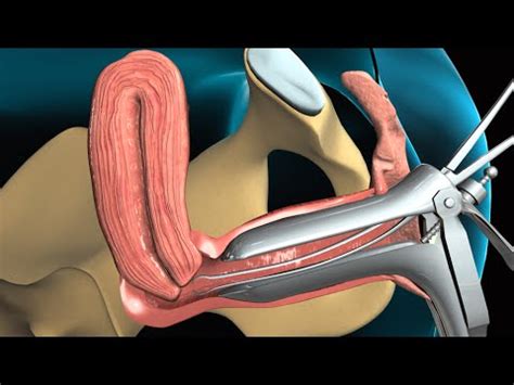 Endometrial Biopsy Youtube