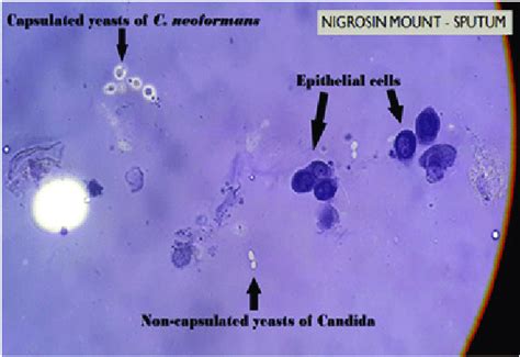 Nigrosin Mount Of Sputum Showing Capsulated Yeasts Of Cryptococcus