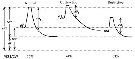 Interpretation Of Spirometric Patterns Download Scientific Diagram