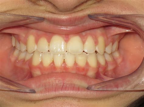 Crooked Overcrowded Teeth Teeth In Line