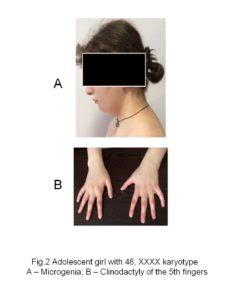 Premature Ovarian Insufficiency In An Adolescent Girl With 48 XXXX Karyotype Case Presentation
