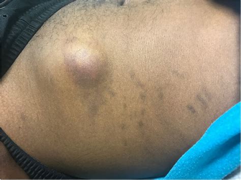 Spigelian Hernia Meded Cases