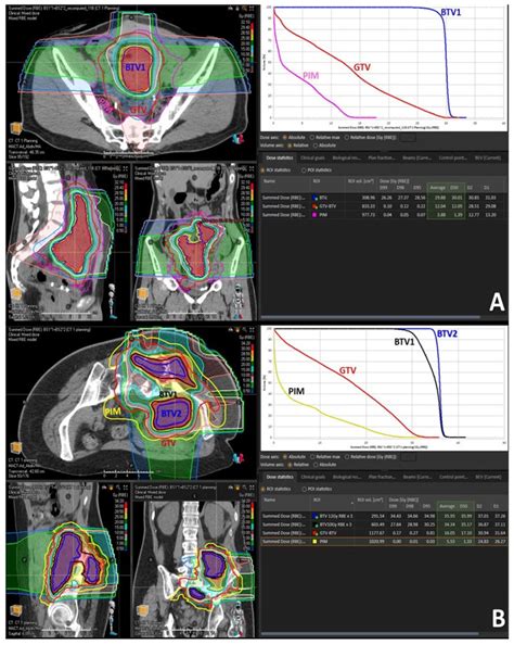 treatment volumes for particle based partial bulky tumor irradiation