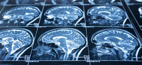 Brain Stem Injury In Car Accidents Understanding The Risks And Legal