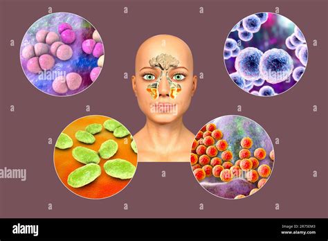 Anatomy Of Rhinosinusitis And Bacteria That Cause Sinusitis Streptococcus Pneumoniae Moraxella