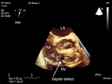 Intraoperative Transesophageal Echocardiography To Evaluate A Gerbode