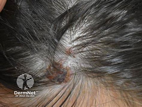 Basal Cell Carcinoma Images