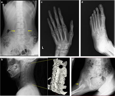 Bilateral Heterotopic Ossification In The Paraspinal Muscles Arrow