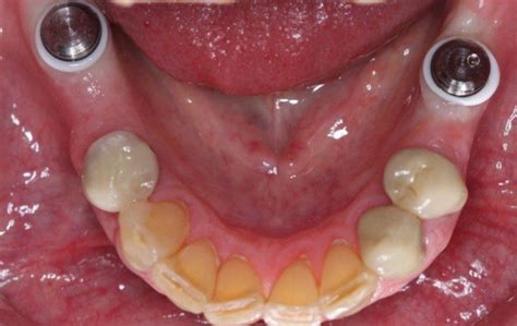 Implant Over Partial Back Teeth Female