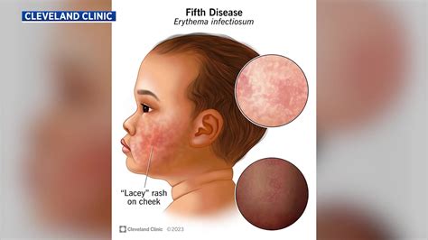 Erythema Infectiosum Lacy Rash
