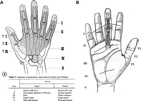 Zone 1 Flexor Tendon Repairs Hand Clinics