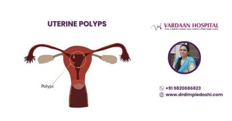 Uterine Polyps Treatment In Goregaon West Mumbai Dr Dimple Doshi